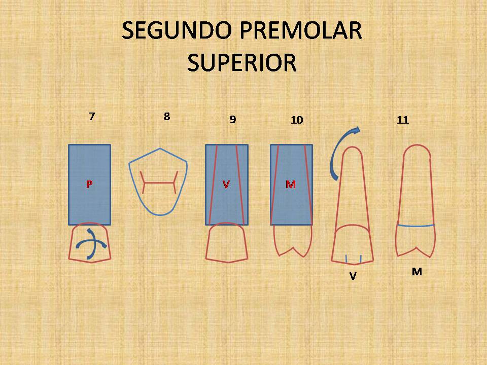 Odontogye: Tallado del segundo premolar superior