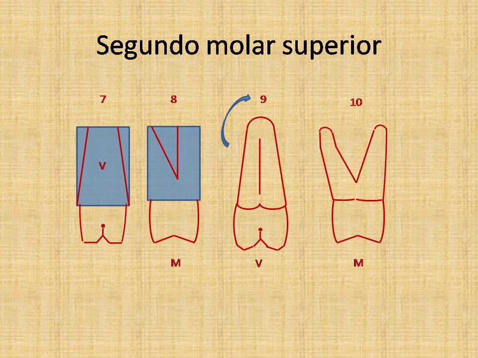 Odontogye: Tallado del segundo molar superior