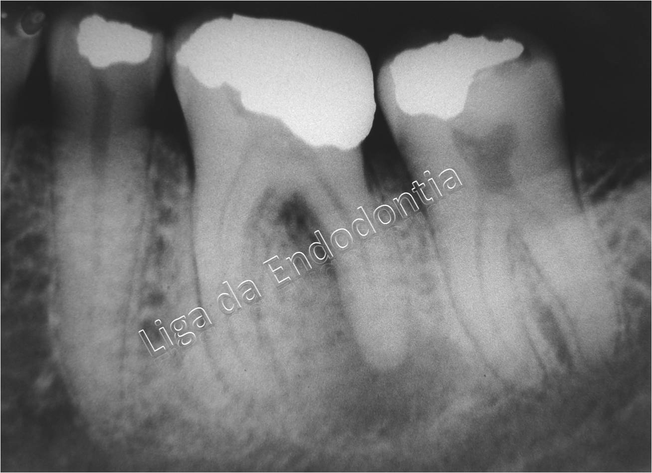 Abscesso Periapical; Abscesso Perirradicular; Abscesso Alveolar Apical ...