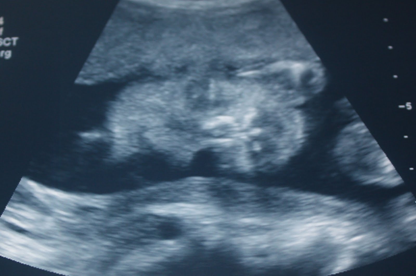Pantel Family Blog: 23 week ultrasound