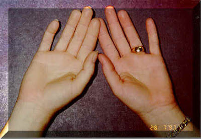 Surgery Mcqs Postgraduation preparation: 29 - white hand sign