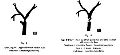 Surgery Mcqs Postgraduation preparation: 66 - Bismuth-Strasberg ...
