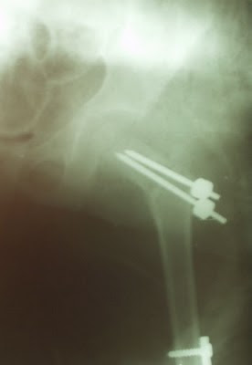 Orthopaedics Mcqs Postgraduation entrance preparation: 90 - Pins ...