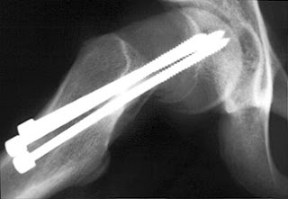 Orthopaedics Mcqs Postgraduation entrance preparation: 90 - Pins ...