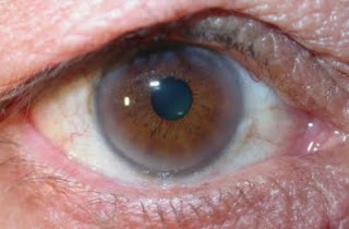 Opthalmology Mcqs Postgraduation entrance preparation: 33 - Gerontoxon ...