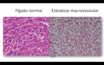 Patologia Básica: Fígado normal e esteatose macro e microvesiculares