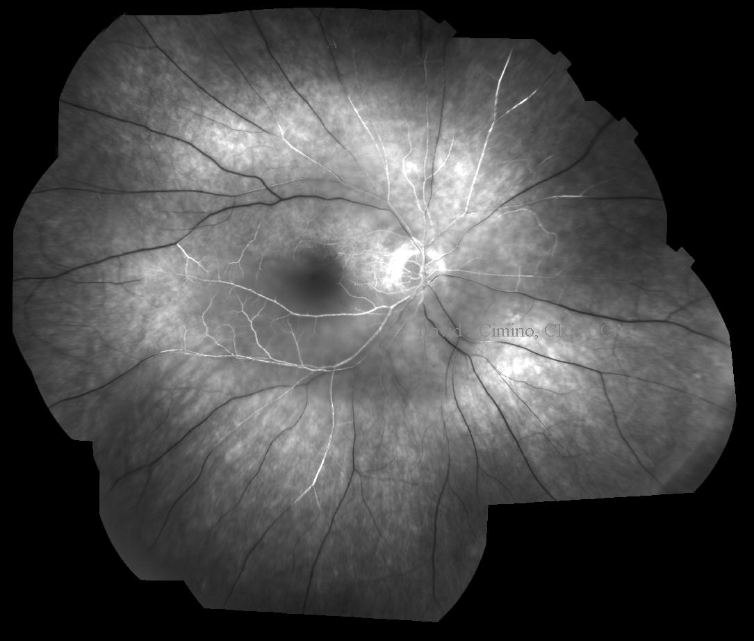 Retinal Photography & Optical Coherence Tomography: Central Retinal ...