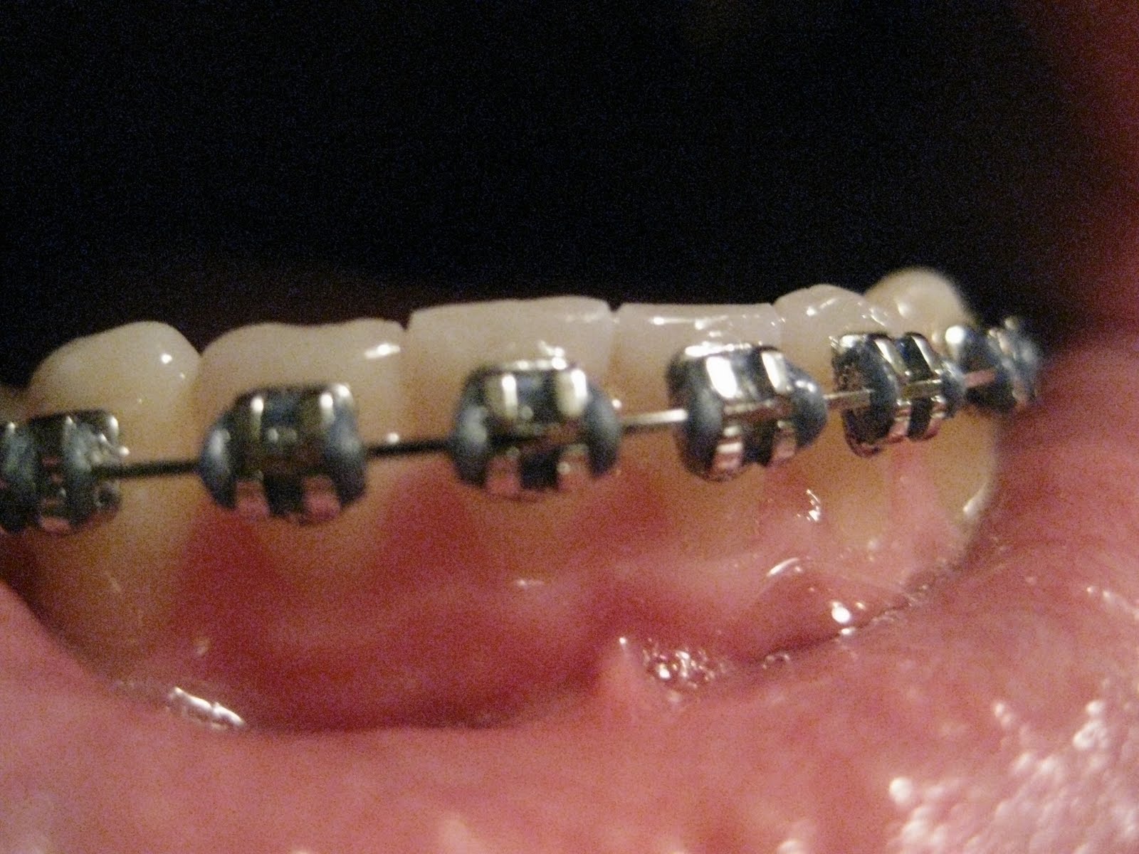 Braces 101 For Teens by Teens: Bracket Bands