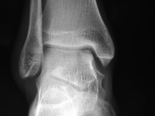 Daily Dose: Osteochondral defect talus