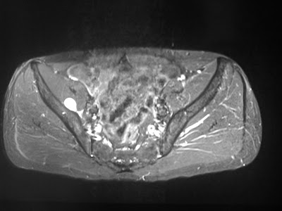 Daily Dose: Iliacus bursa