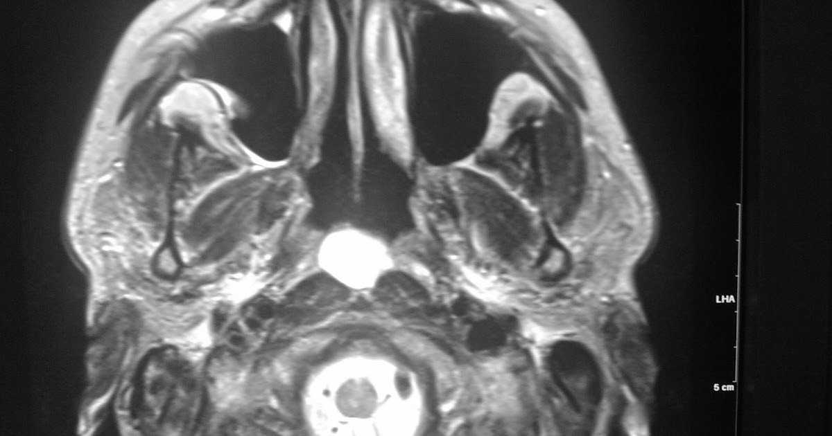 Daily Dose: Tornwaldt' cyst