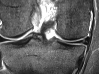 Daily Dose: Vertical tear of the meniscus