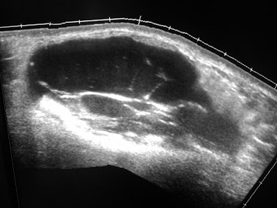 Daily Dose: Abdominal wall seroma