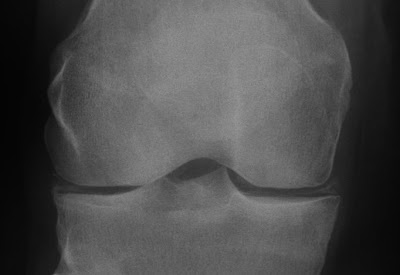 Daily Dose: MRI of chondrocalcinosis?