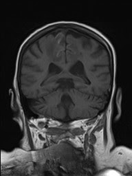 Daily Dose: A rare case of bilateral ACA infarct