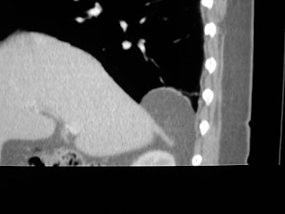 Daily Dose: Focal eventration of diaphragm