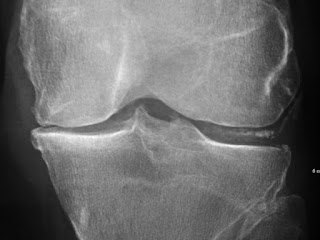 Daily Dose: Chondrocalcinosis