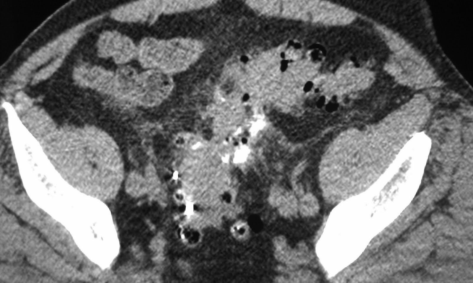 Daily Dose: Colovesical fistula