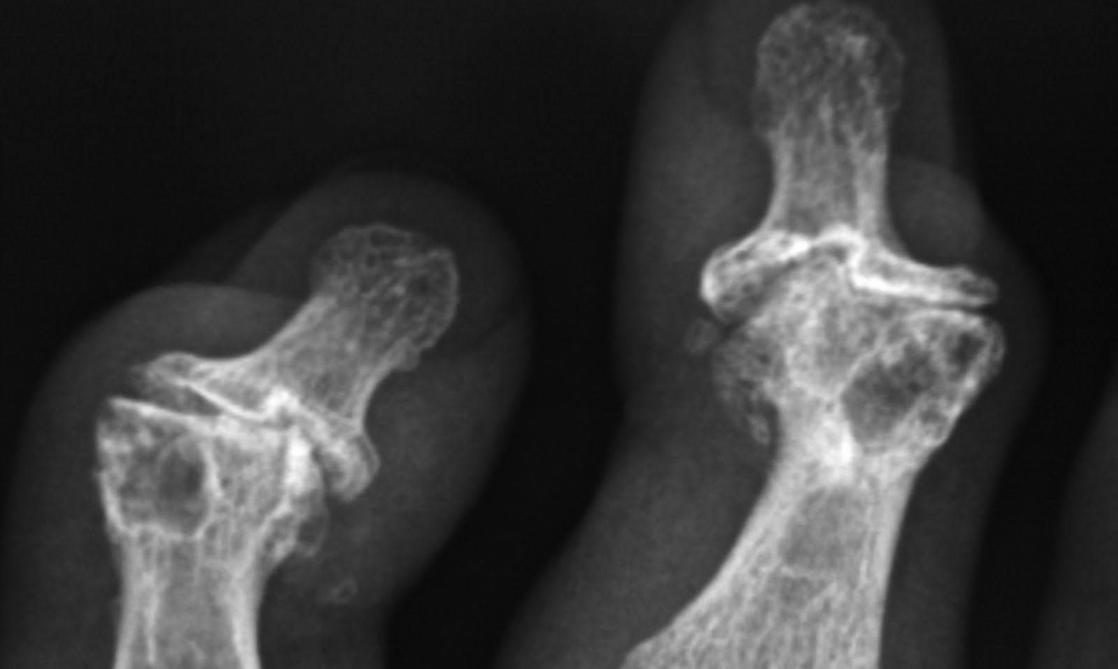 Daily Dose: Advanced osteoarthritis of DIPJ
