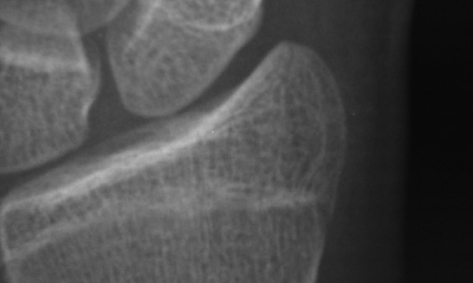 Daily Dose: Salter Harris type 3 fracture