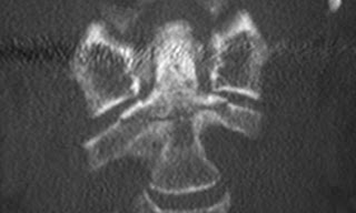 Daily Dose: Odontoid peg fracture