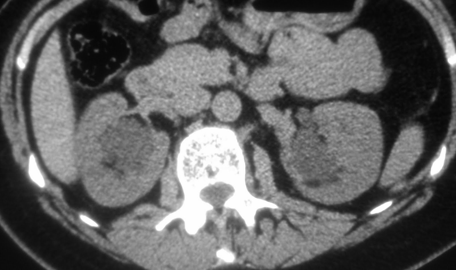 Daily Dose: Peripelvic cysts