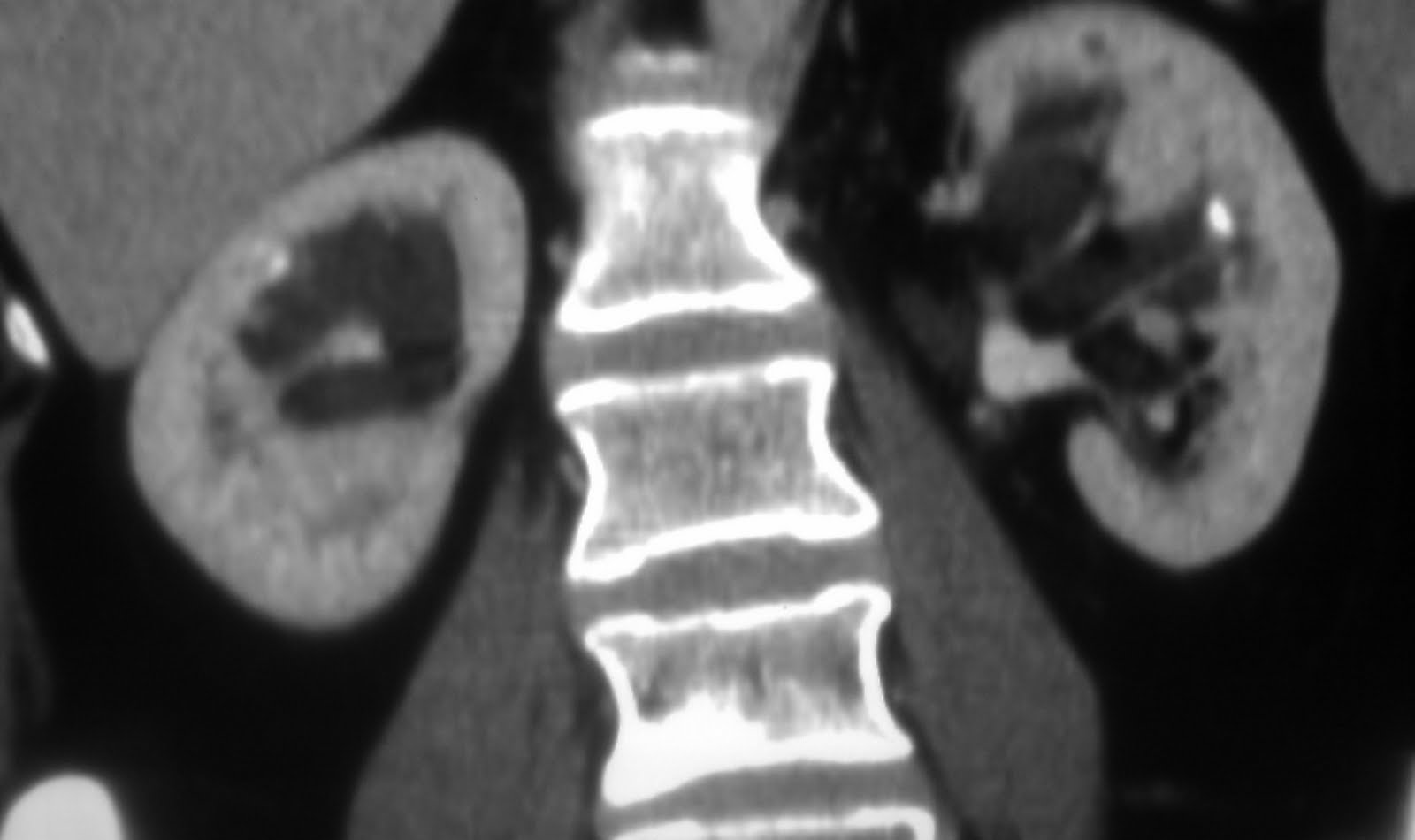 Daily Dose: Peripelvic cysts