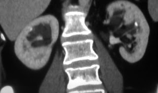 Daily Dose: Peripelvic cysts