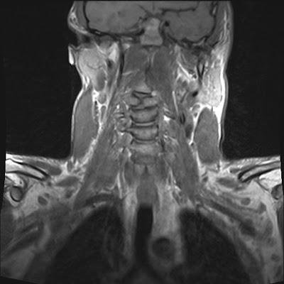 Daily Dose: Butterfly vertebra
