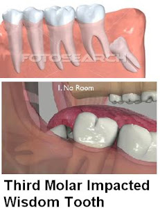 Pictures & Images: Picture of Third Molar Impacted Wisdom Tooth