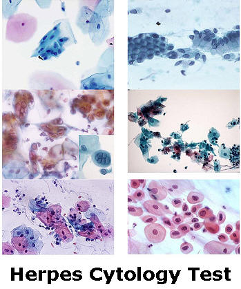Pictures & Images: Picture of Herpes Diagnosis Tests