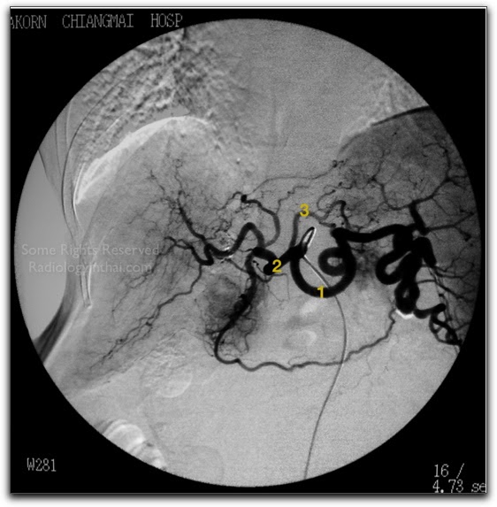 RiT radiology: Hepatic angiography: Accessory Left Gastric Artery