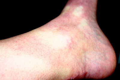 The G's: The case of the curious purple foot