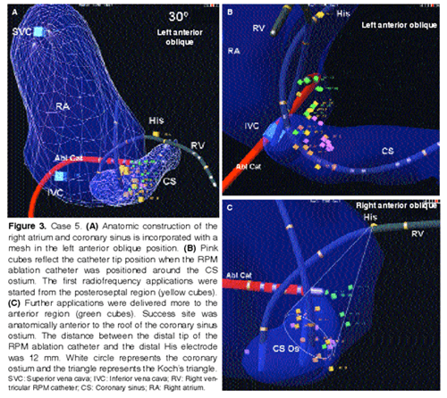 What I Learned from Daniel : The Blog: Cardiac Ablation