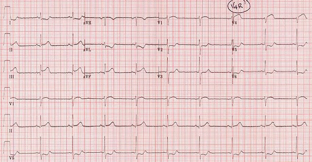 Right Ventricular Infarction | Medicalchemy Cardiology
