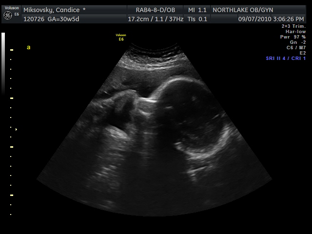 The Miksovskys: Sono Pics - 31 weeks