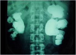 Cálculo coraliforme