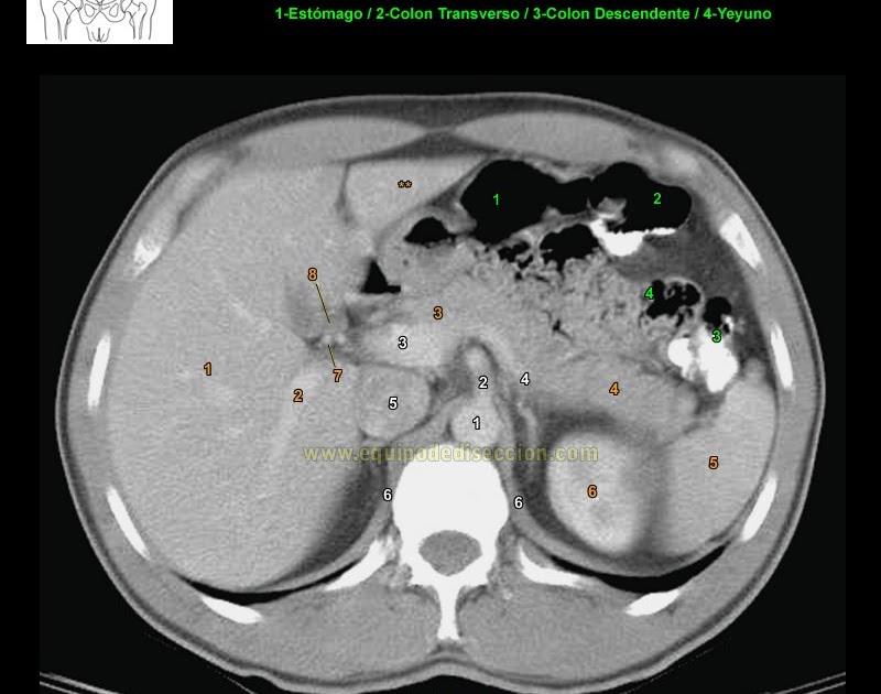 tac: TAC abdomen Nº1 (L1-L2)