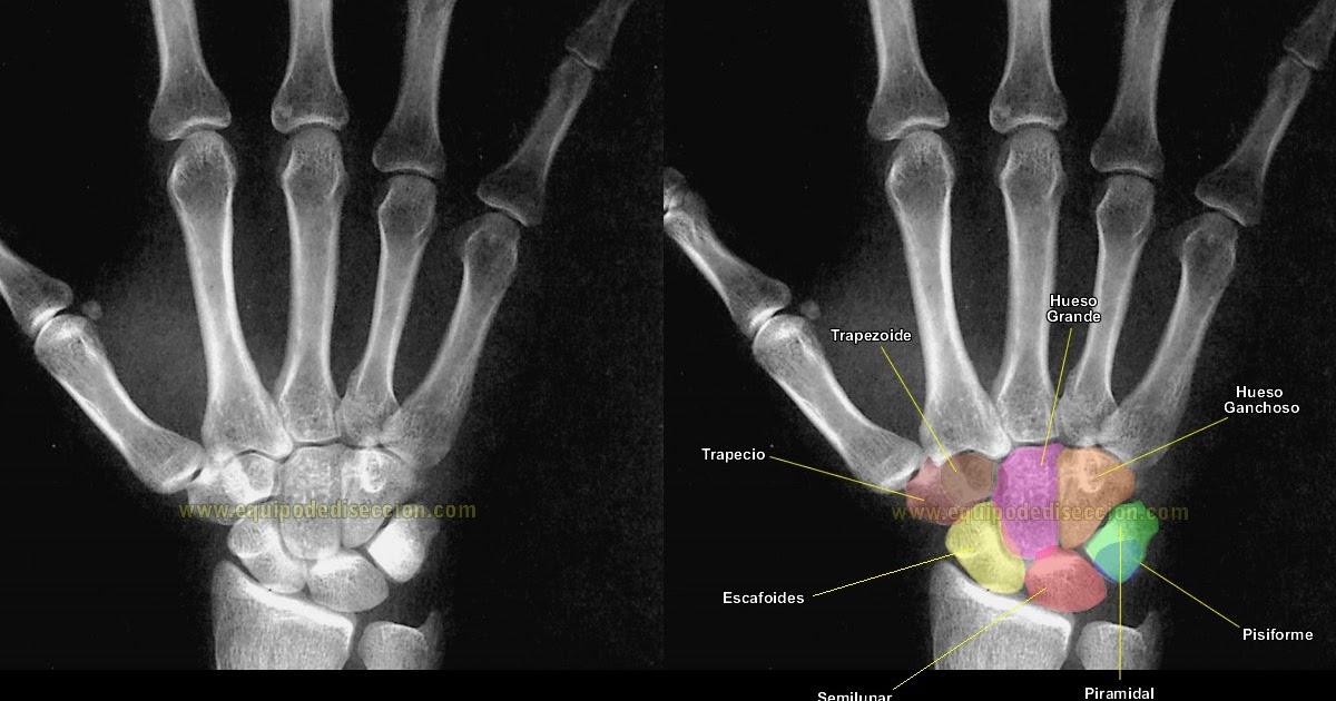 rx: Rx Anteroposterior Carpo