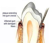 all about my world: Gingivitis