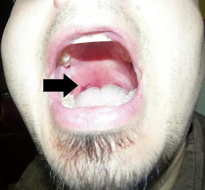 TREAT WITH THE WHOLE-HEARTED: Peritonsiler abscess (PTA / Quinsy) 9