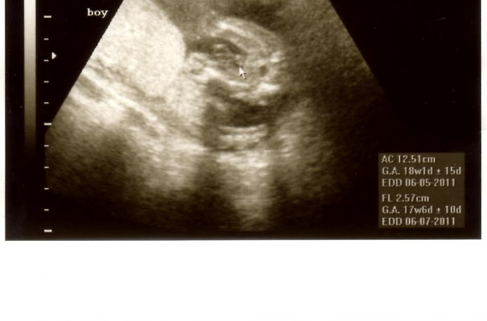 Growing Jacobsons: 17 week ultrasound/OB visit