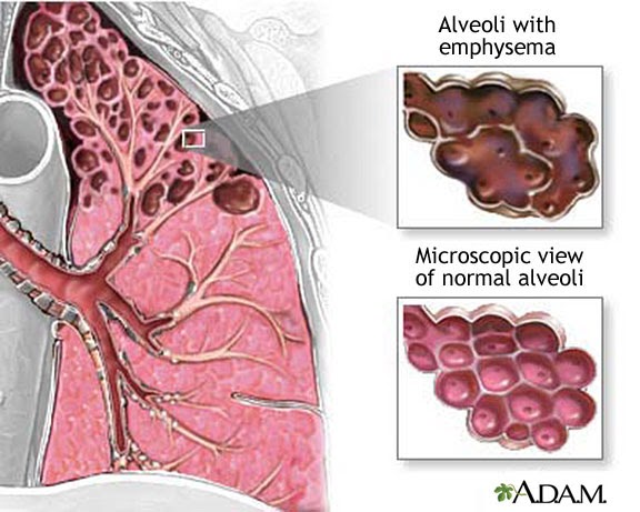 Artificial lungs: picture of damaged alveoli