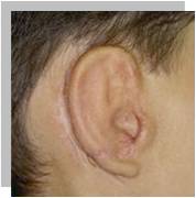 Alteraciones Audio-Vestibular: Microtia