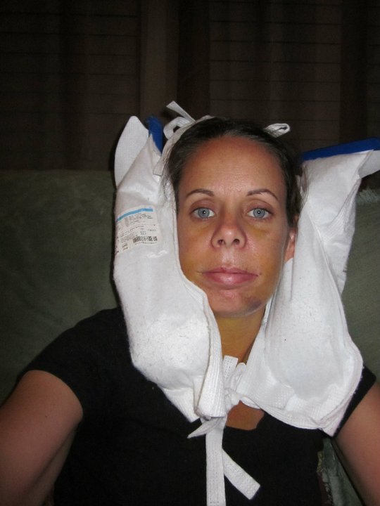 Cheryl's Upper & Lower Jaw Surgery