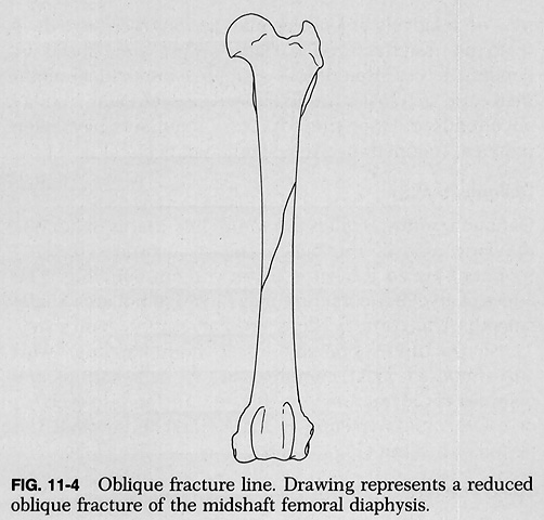 Anatomy & Physiology: Bone Fractures