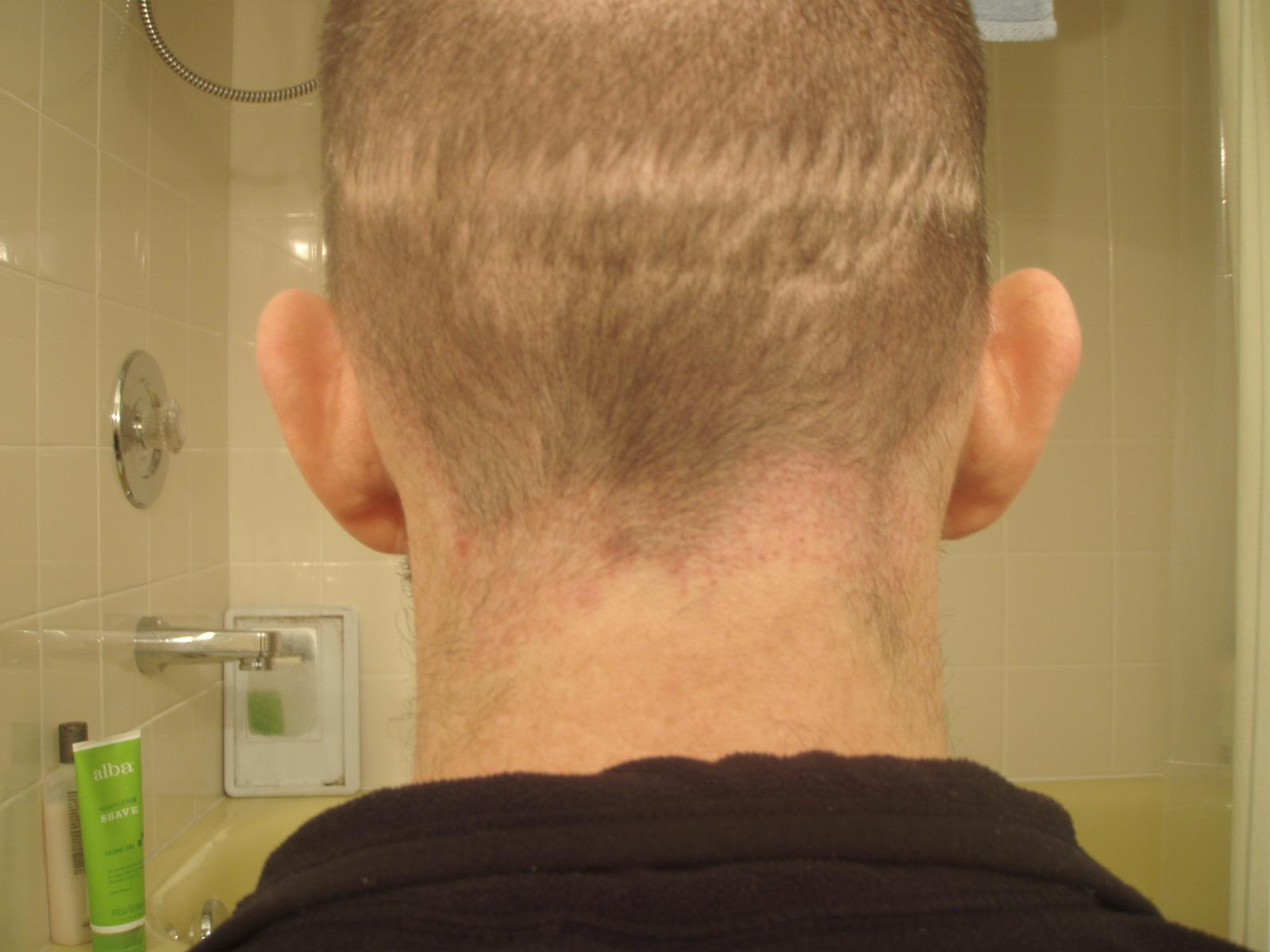 Hair Transplant Victims: How NuHart Hair Transplants ruined my life