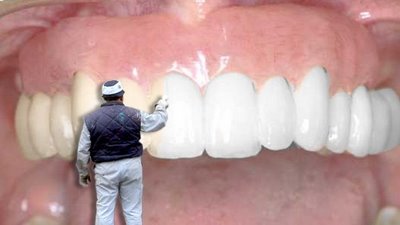 salud oral-tecnisalud: QUE ES UN CALCULO DENTAL