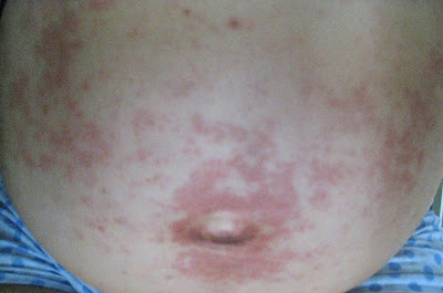 Journey of Two + 1: PUPPP in My 2nd Trimester (24 Weeks of Pregnancy)