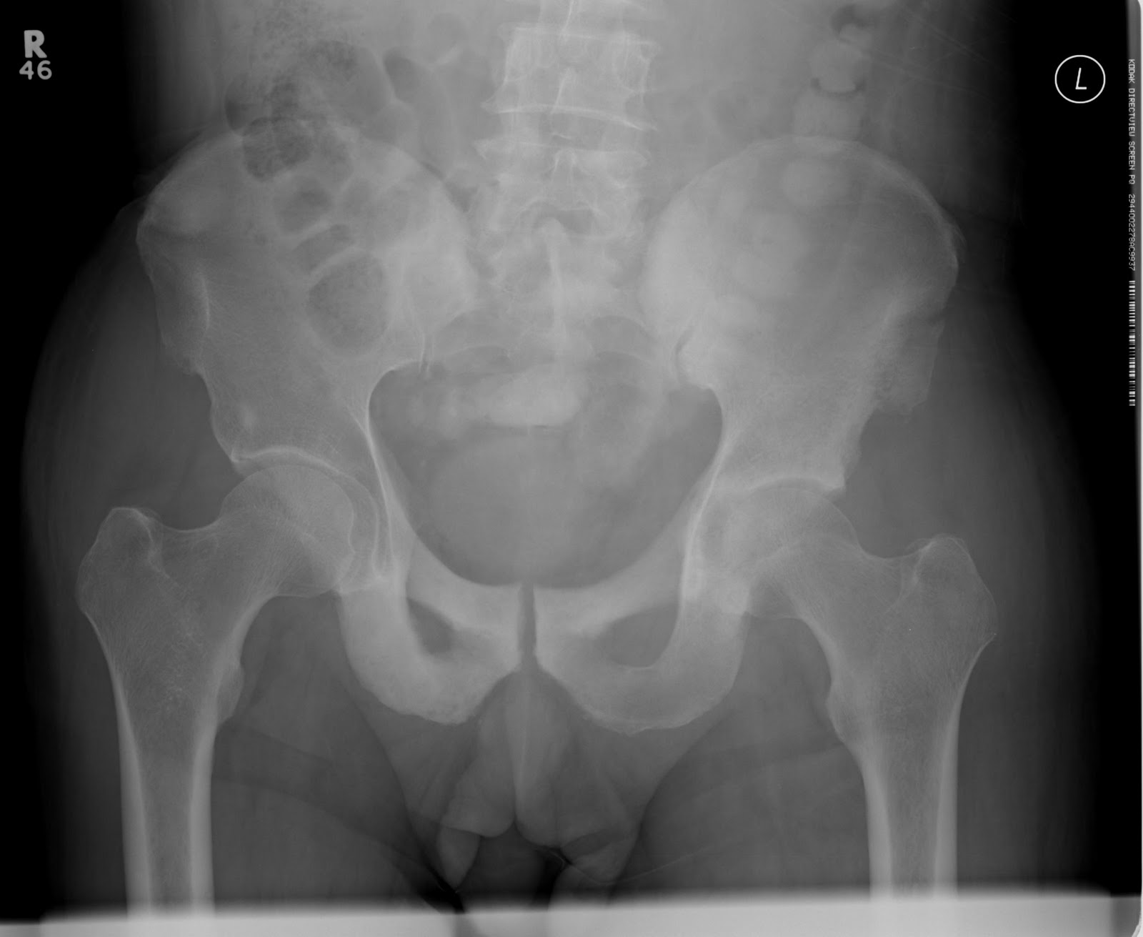Post Gad: Sclerotic mets from Prostate CA